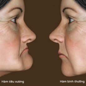 Giải Đáp: Chi phí TRỒNG RĂNG HÀM bị mất giá bao nhiêu tiền?