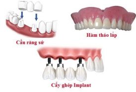 Giải Đáp: Chi phí TRỒNG RĂNG HÀM bị mất giá bao nhiêu tiền?